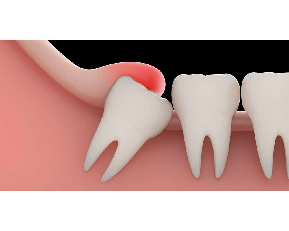 ¿Cuáles son los síntomas de la pericoronitis? - OdontoVida