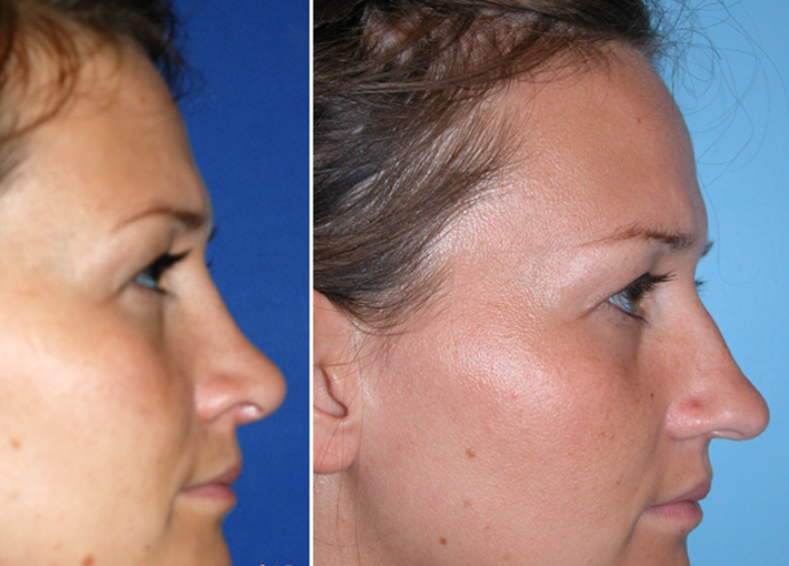 Burun Estetiği resimleri