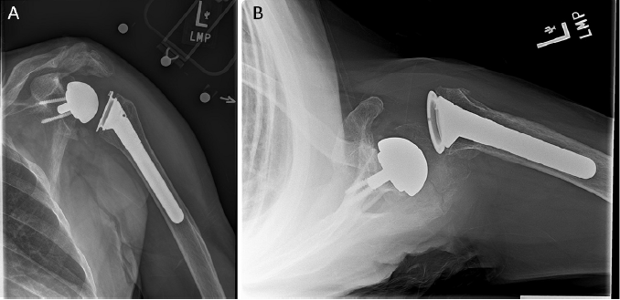 UW Shoulder and Elbow Academy: Reverse total shoulder failure from ...