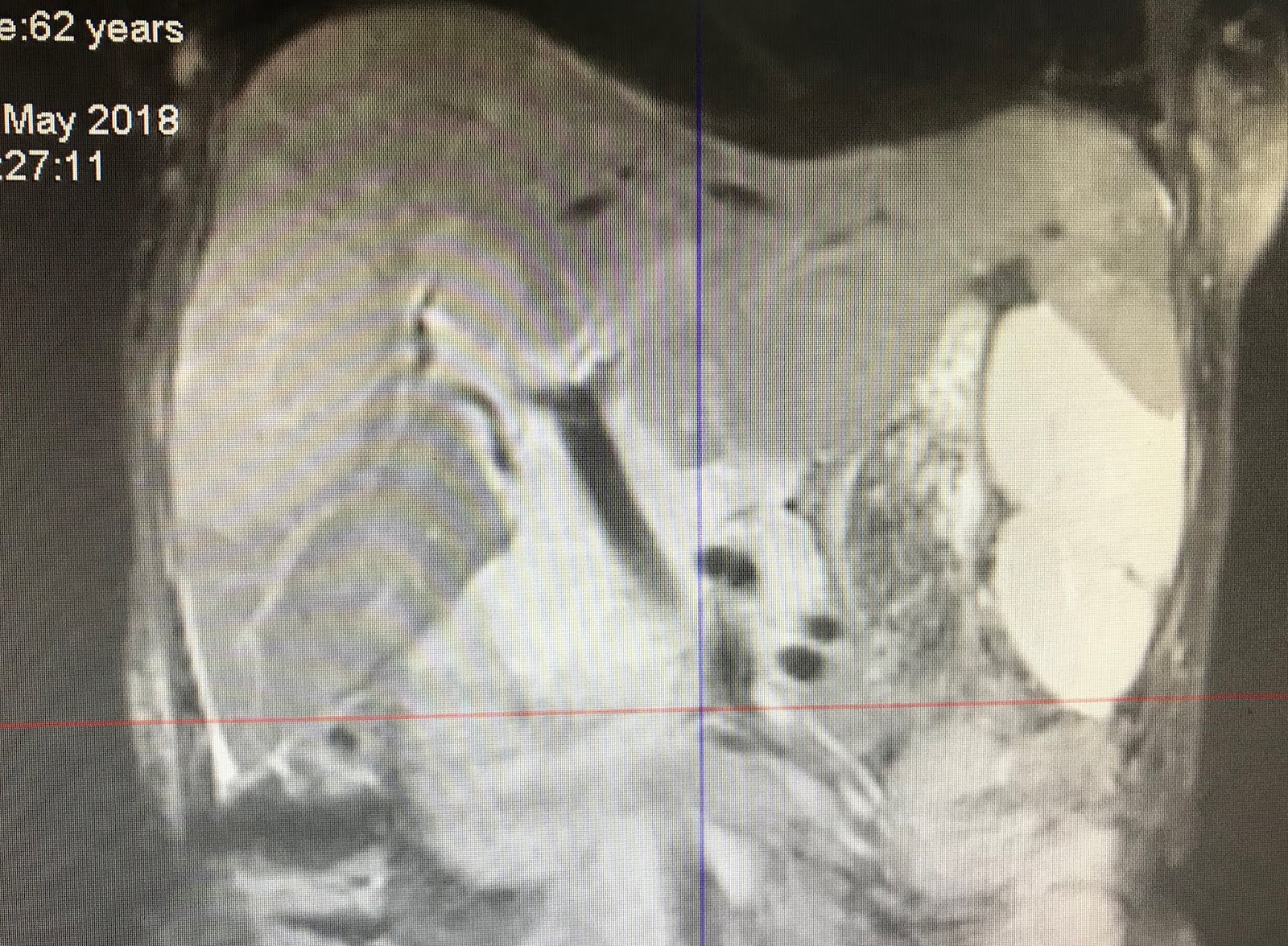 VIETNAMESE MEDIC ULTRASOUND: CASE 494: PRIMARY LIVER LYMPHOMA (PLL),Dr ...