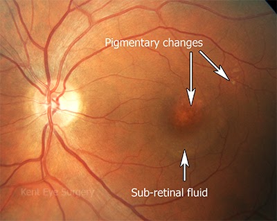 dr. Ferry Fawzi Annor: Central Serous Retinopathy ( CSR )