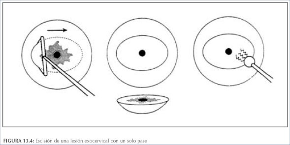 GABINETE MEDICO: TRATAMIENTO CON LEEP