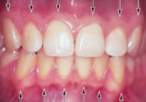 UNIDAD III: Encía Periodontológica