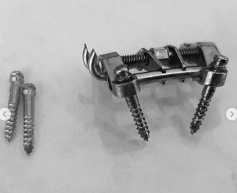 My experience with the MSE (maxillary skeletal expander): MSE REMOVAL ...