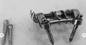 My experience with the MSE (maxillary skeletal expander): MSE REMOVAL ...