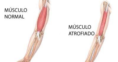 Sistema Músculo Esquelético: Distrofia Muscular
