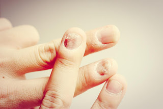 Treatment of scaling of the skin around the nails and its causes