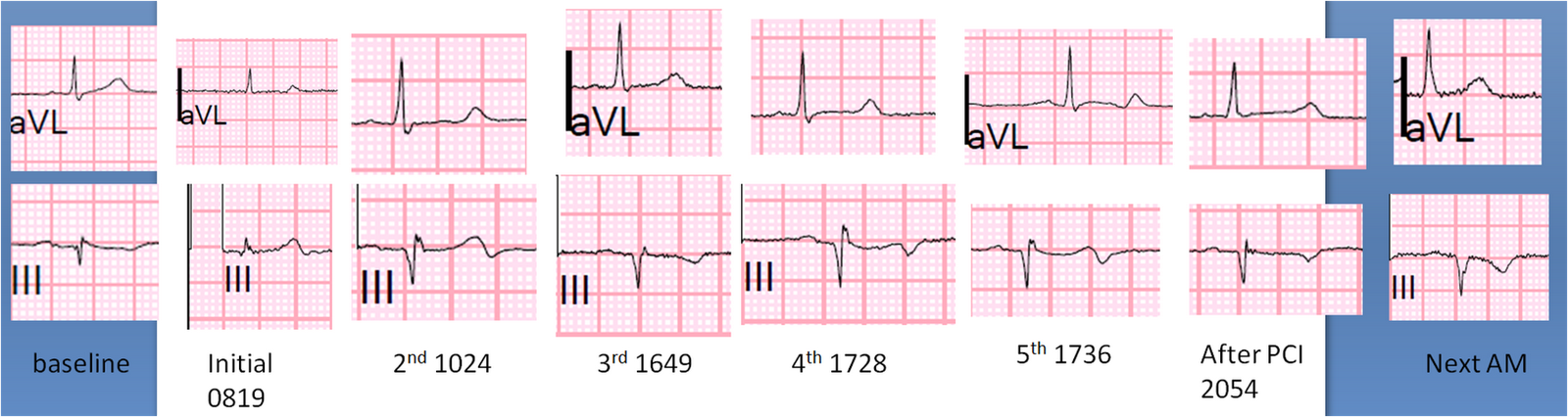 Dr. Smith's ECG Blog: Inferior Dynamic T-waves