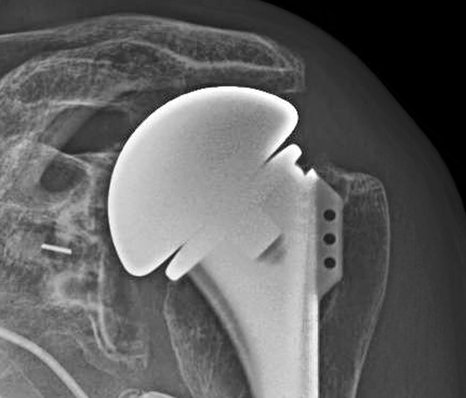 UW Shoulder and Elbow Academy: The rotator cuff deficient shoulder ...