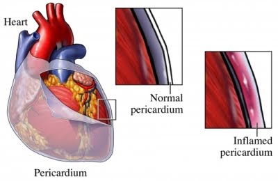 El Cuerpo Humano: EL PERICARDIO y la pericarditis