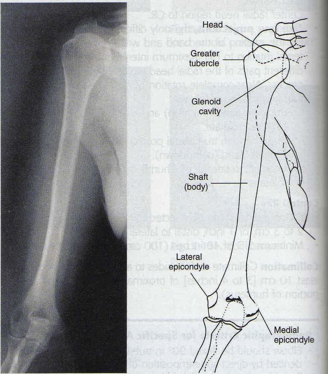 Radiografi: contoh laporan kasus fraktur pada Os Humerus