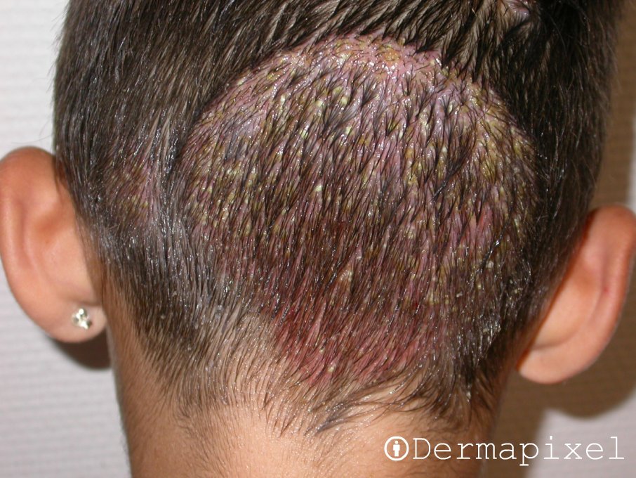 Pelos Faciais Irregulares