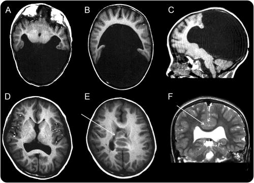 pediatric neurology: Discordant holoprosencephaly in monozygotic twins ...
