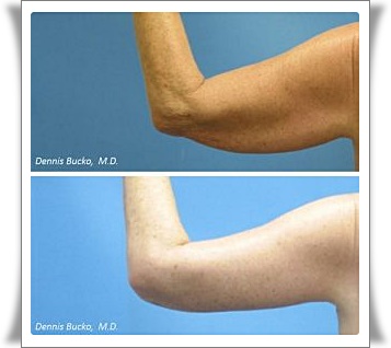 Eliminate Flabby Fat & Skin/Upper Arm Lift : Oberarmstraffung ...
