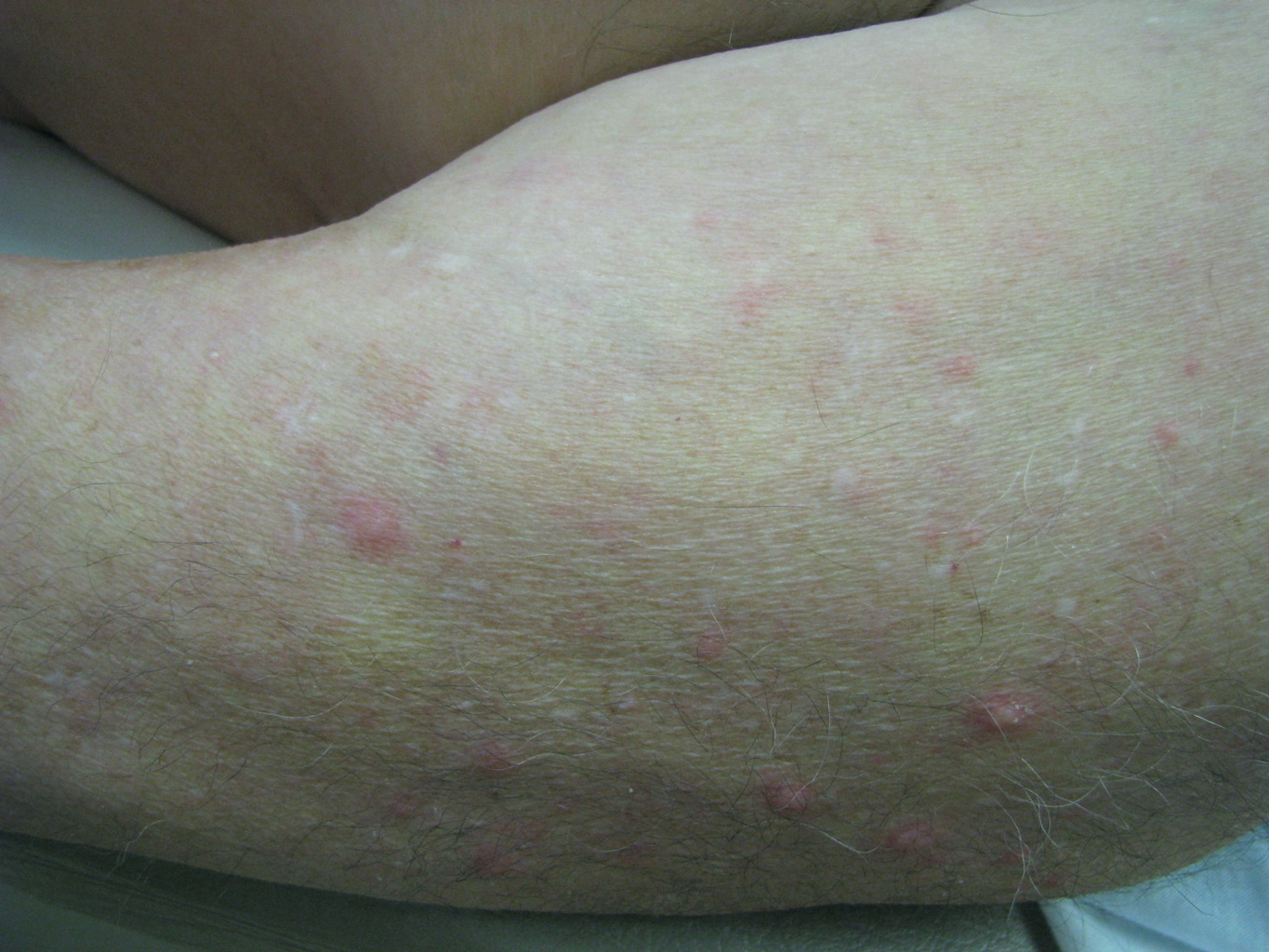 Warning Signs Of Eruptive Xanthomatosis A Skin Condition