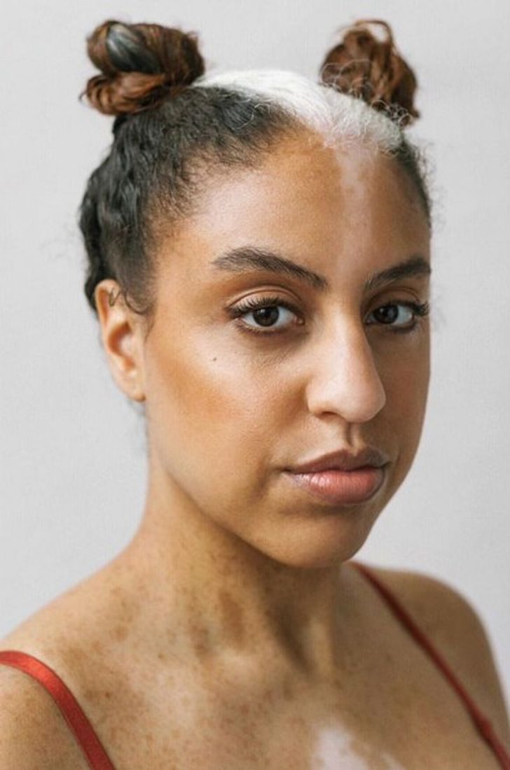 Beautiful Women With Vitiligo Funnymadworld