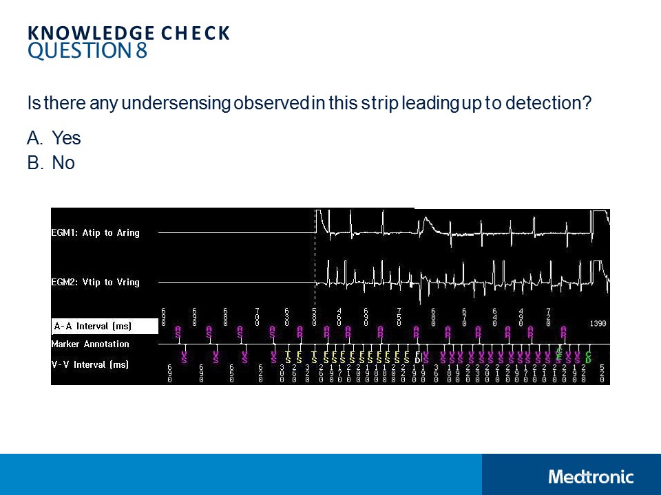 CVT Mohd Farid: Concept Of ICD Technology-Sensing & Detection-Medtronic ...