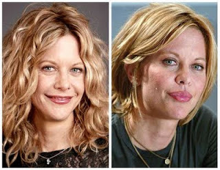 Meg Ryan Plastic Surgery Before and After Facelift and Botox - Star ...