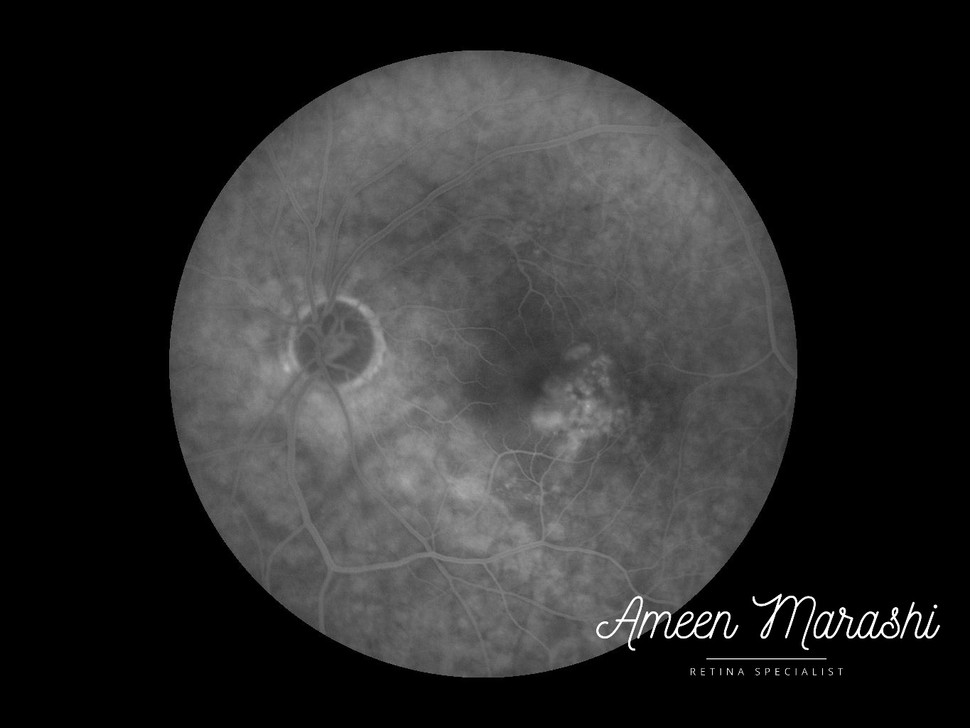 Polypoidal choroidal vasculopathy