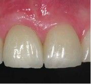Worldwide Dentists Community: Treatment of bony defects and extraction ...