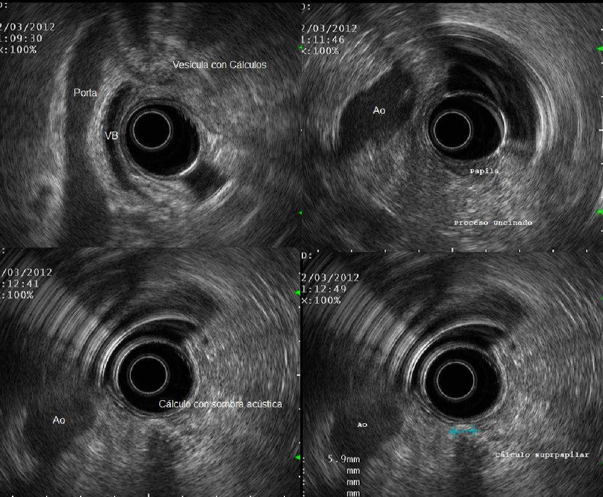 La endosonografía con el