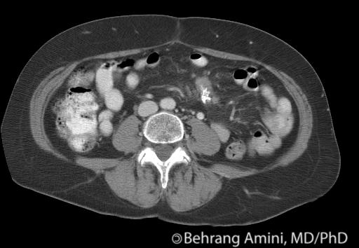 Roentgen Ray Reader: Calcified Mesenteric Masses: Differential Diagnosis