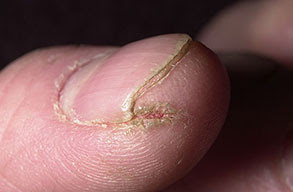 Bella10 Nails: How to Heal Fingertip Cracks and Fissures