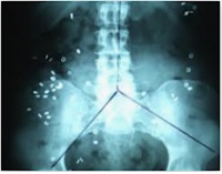 PROTOCOLO DE ESTUDIOS ESPECIALES: TRÁNSITO INTESTINAL