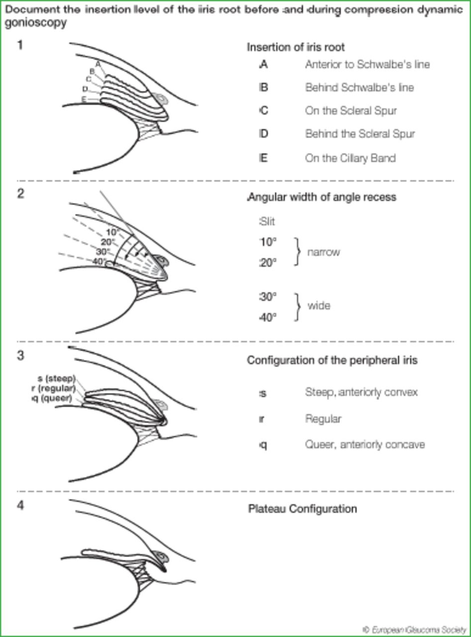 Ophthalmology Notes: Spaeth Gonioscopic Grading System (SGGS)