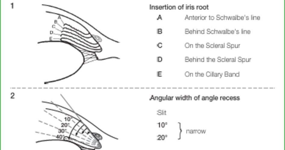 Ophthalmology Notes: Spaeth Gonioscopic Grading System (SGGS)