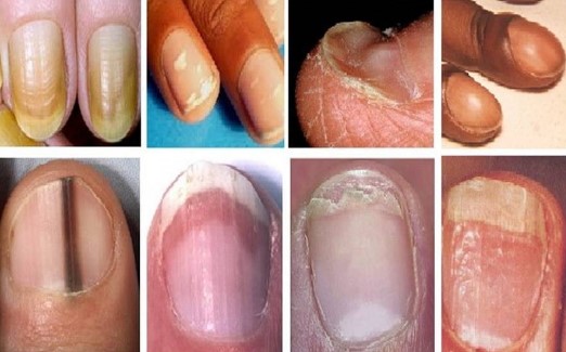 This Is What Your Fingernails Say About Your Health - HEALTH and WELLNESS