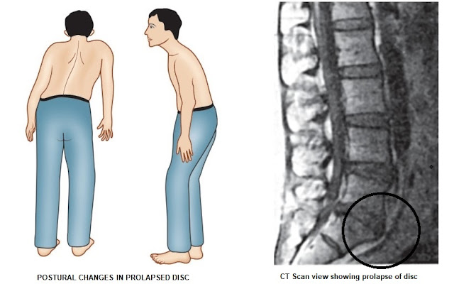 PROLAPSED INTERVERTEBRAL DISC(PIVD) EXERCISES, CAUSES, SYMPTOMS AND ...