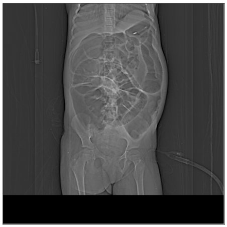 Congenital Megacolon- CT - Sumer's Radiology Blog