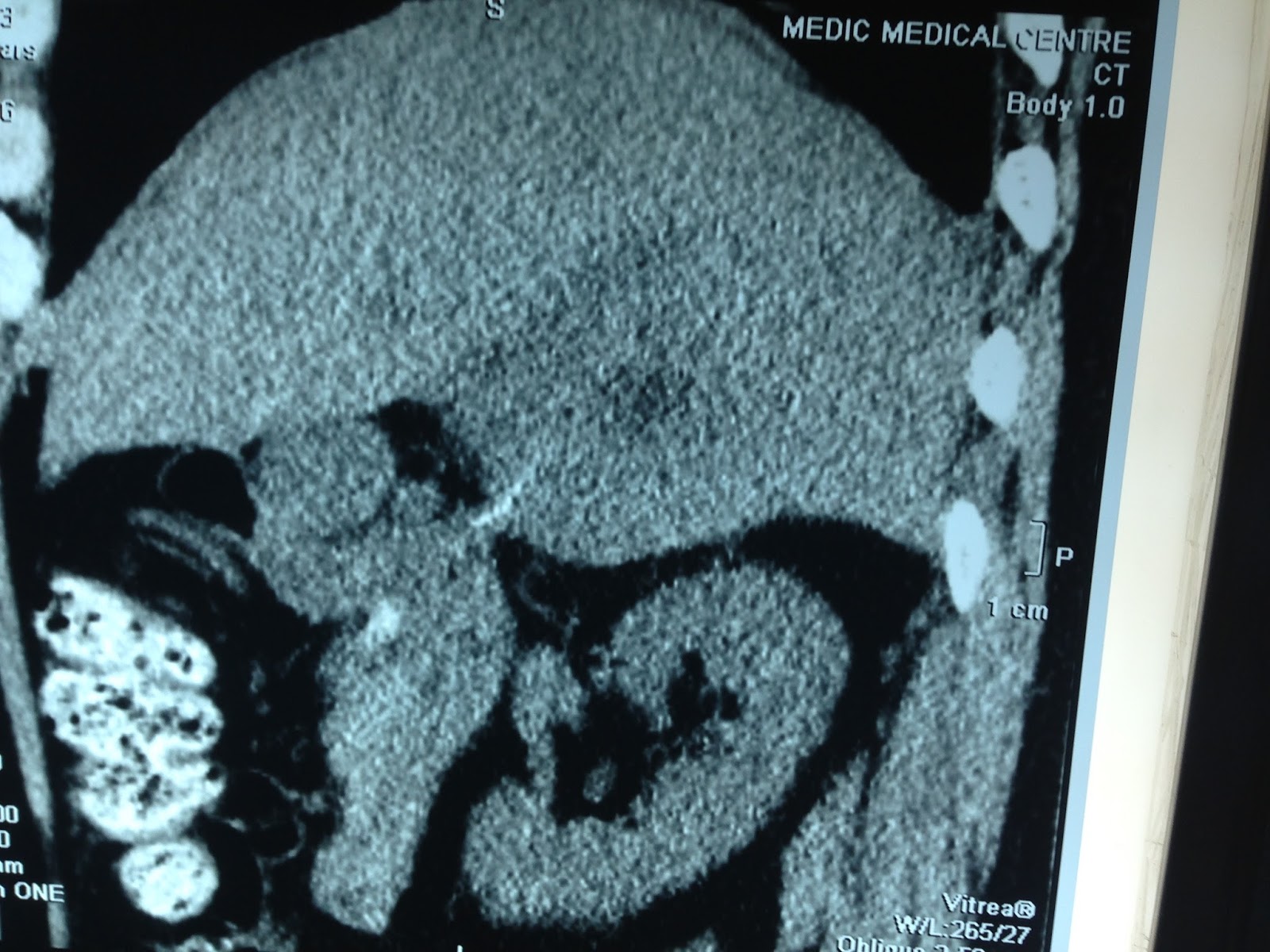 VIETNAMESE MEDIC ULTRASOUND: CASE 387: LIVER ABSCESS DUE TO FISHBONE ...