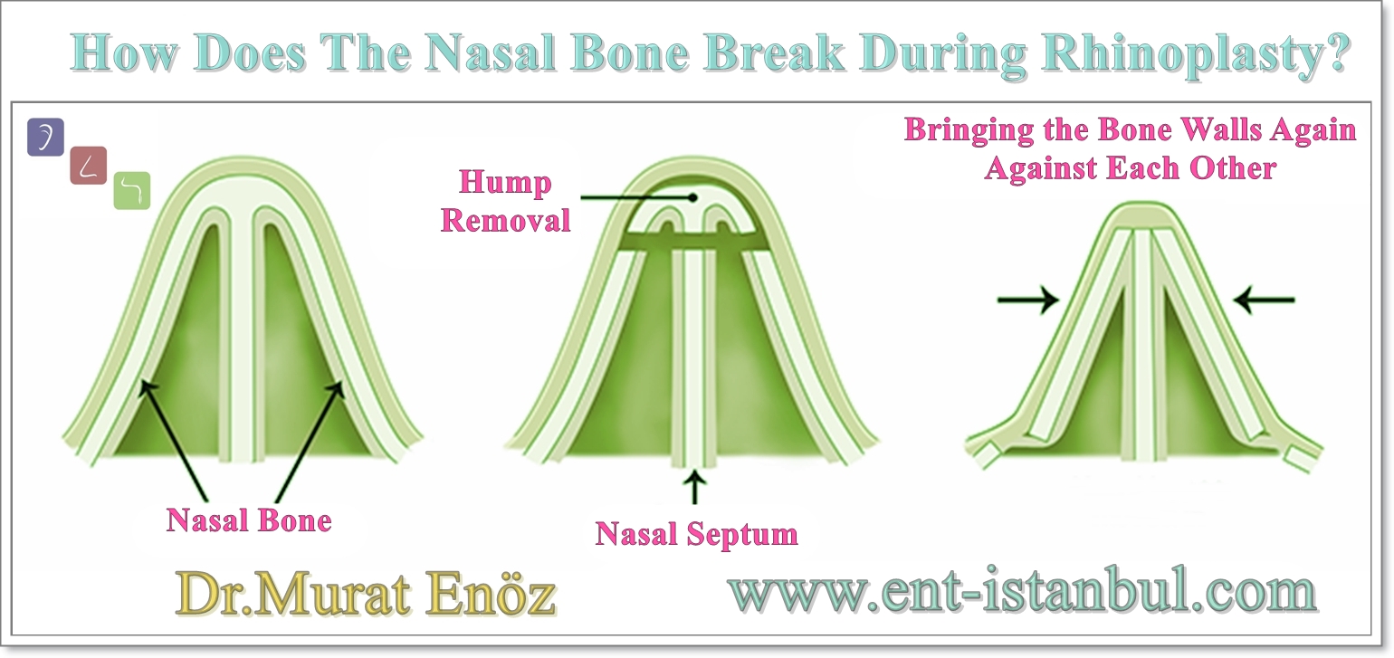 How Does The Nasal Bone Break During Rhinoplasty?