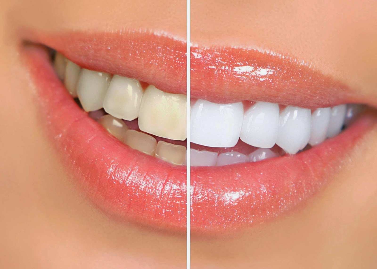 How to Eliminate Coral Teeth Naturally without Pain and Expensive ...