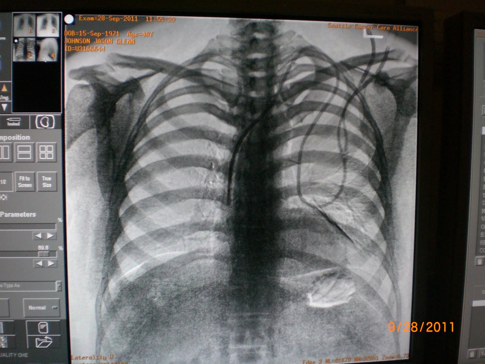 Running with CML: Hickman Line