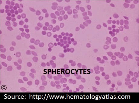 Lab Atlas: Spherocyte