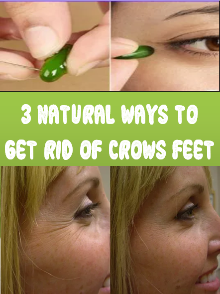 3 NATURAL WAYS TO GET RID OF CROWS FEET - TOP 5 DIY