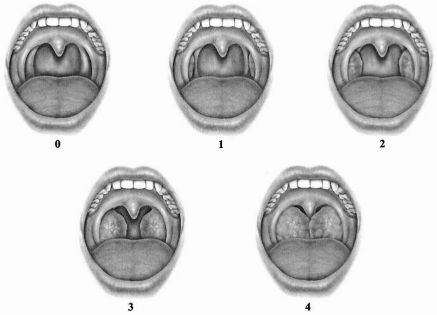 Berbagi Informasi Kedokteran: Tonsilitis
