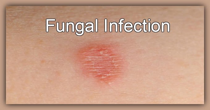 Fungal Infection Tips For Health Care | Causes of Symptoms