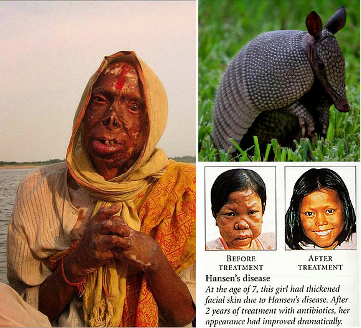 List 99+ Pictures Pictures Of Leprosy In Bible Times Full HD, 2k, 4k