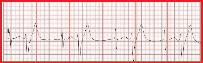 EKG Rhythm Strip Quiz 176