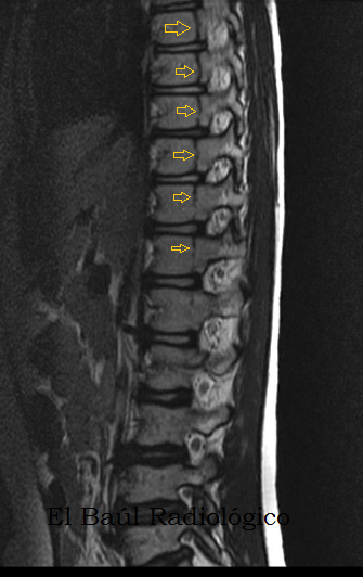 El Baúl Radiológico: SINCONDROSIS NEUROCENTRAL DE LOS CUERPOS ...