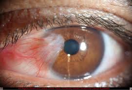 There's A Bump on My Eye Part 3: Pterygium - Eyedolatry