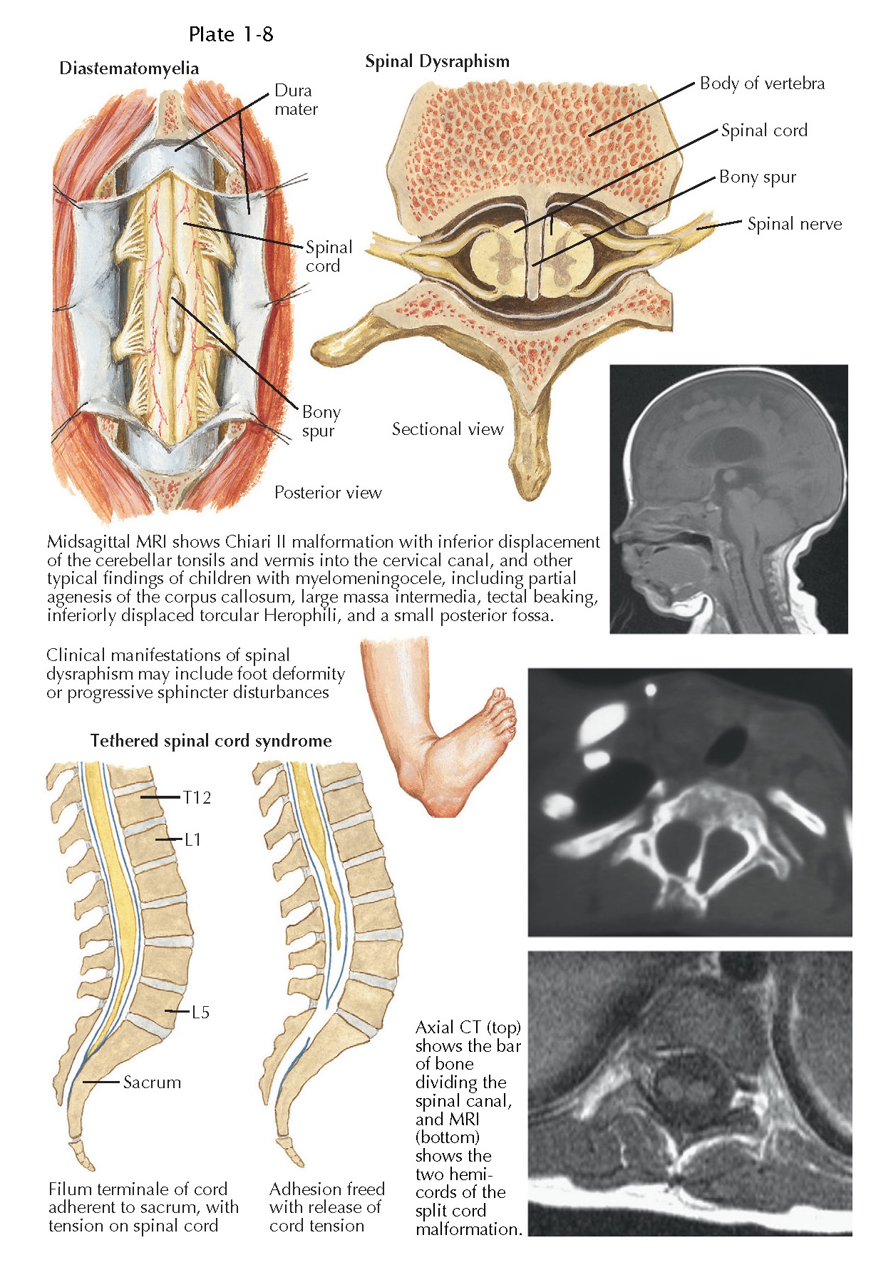 SPINAL DYSRAPHISM - pediagenosis