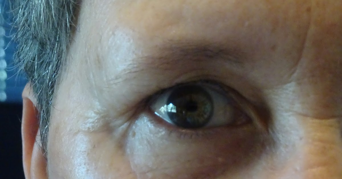 Mark & Teri's Travels: Pucker Up!! - Eye Surgery