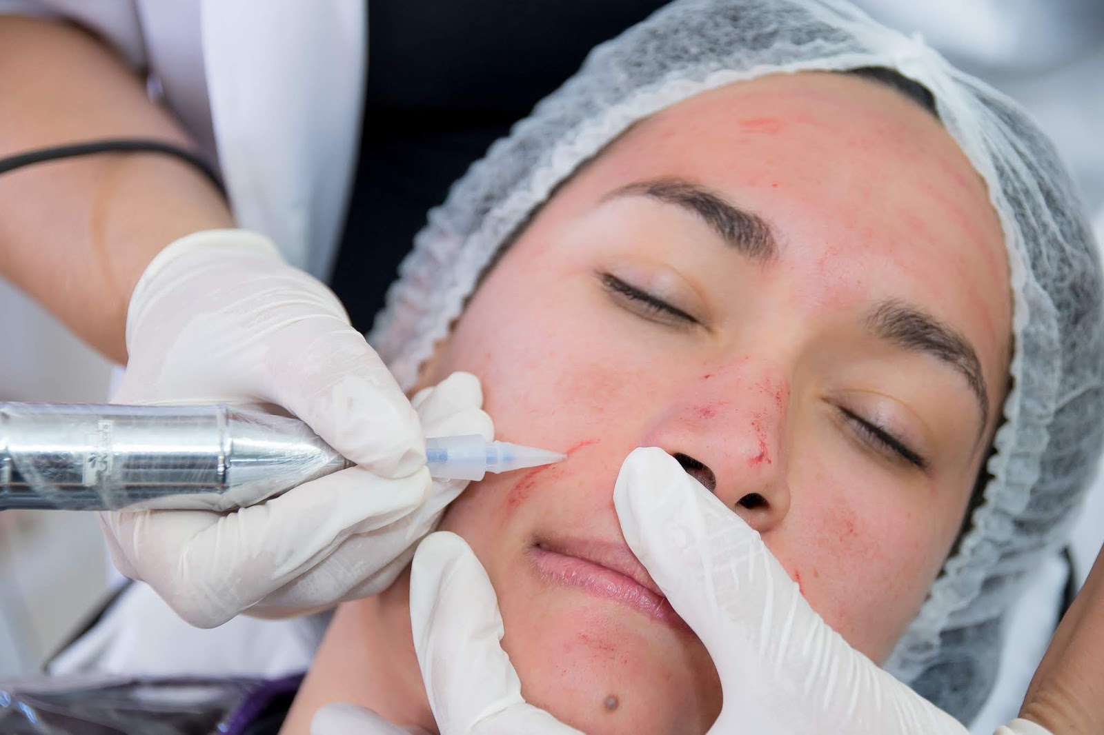 Curso de Microagulhamento Yasmine Cunha, Yasmine Mol II Técnicas ...