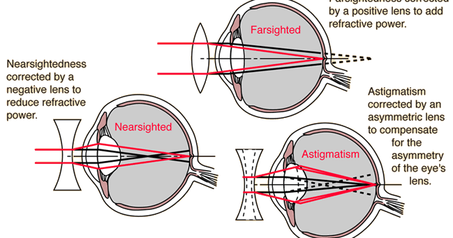 Correction of Common Vision Defects