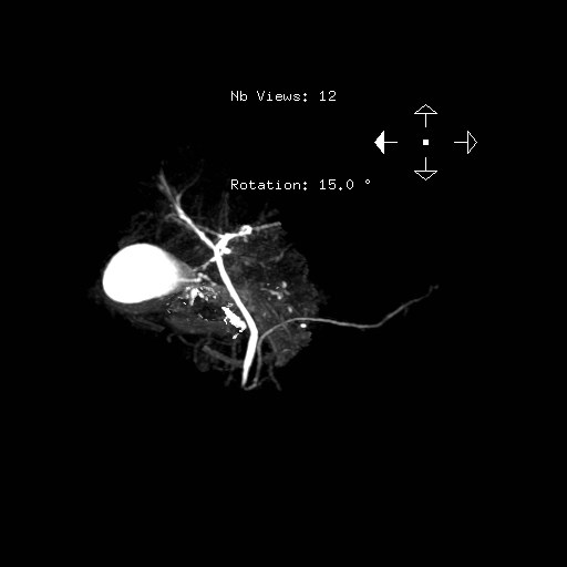 Abdominal Section: Normal MRCP.
